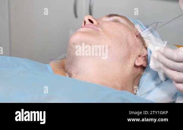 Beauty surgical operation to hide signs of aging. Flaccid face skin ...