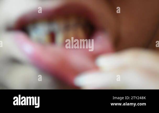 The girls show aphtha on the inside of the mouth, one of the vesicles ...