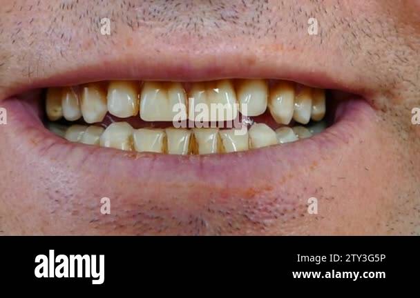 Neglected teeth Stock Videos & Footage - HD and 4K Video Clips - Alamy