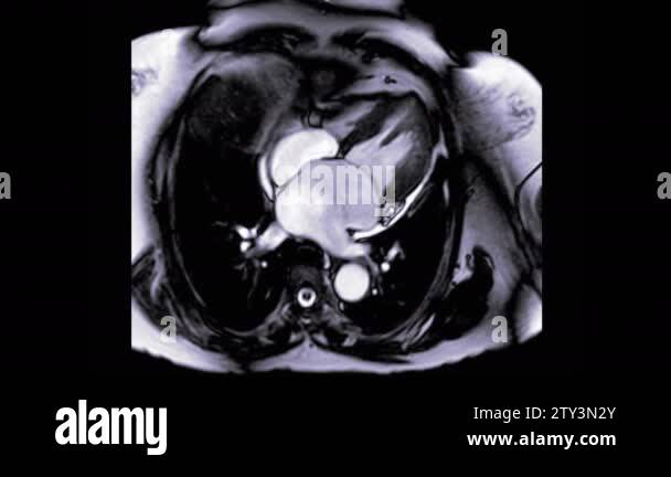 MRI heart or Cardiac MRI magnetic resonance imaging of heart in 3 ...