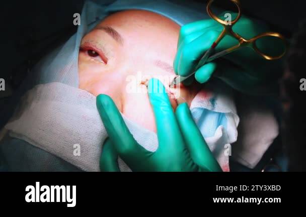 The surgeon is performing an operation on the eyes, close-up ...