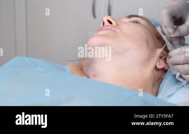 Beauty surgical operation to hide signs of aging. Flaccid face skin ...
