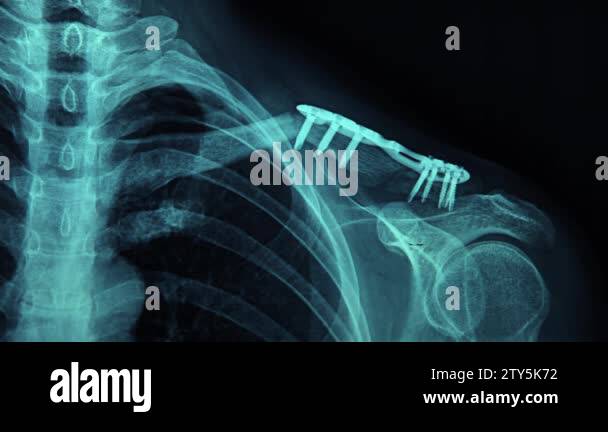 MRI Scan Broken Collar Bone (Broken Clavicle), Human Body Xray Monitor ...