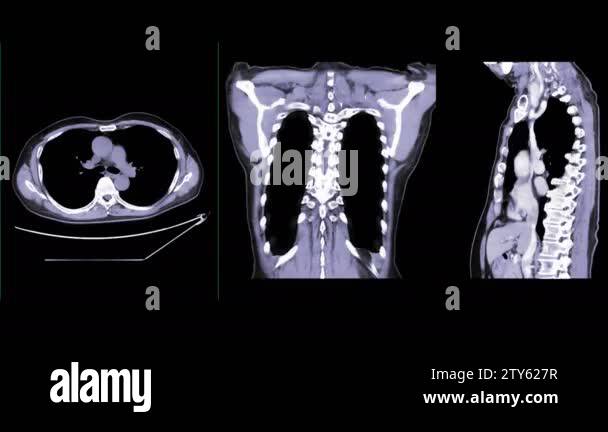 Chest X-ray with 3D rendering image CTA whole aorta inside chest Stock ...