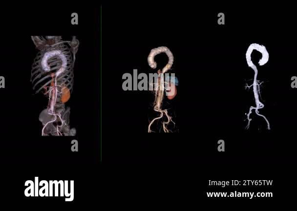 CTA Whole aorta 3D rendering image turn around on the screen for detect ...