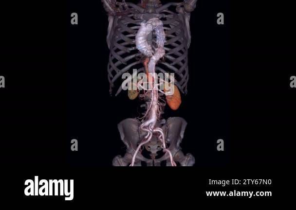 CTA Whole aorta 3D rendering image turn around on the screen for detect ...
