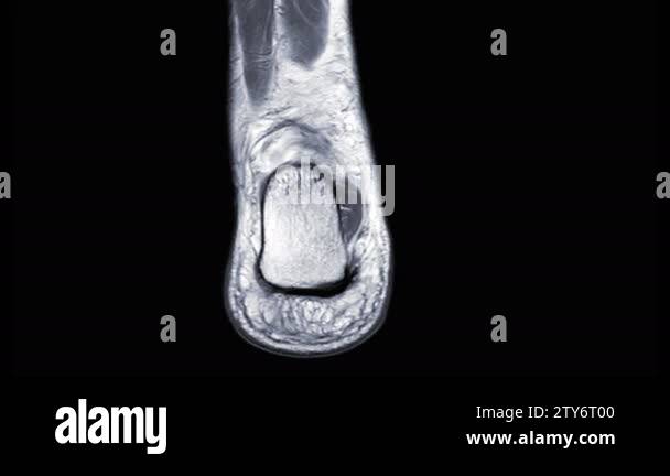 mri ankle joint coronal T2 for diagnosis tendon of ankle joint injury ...