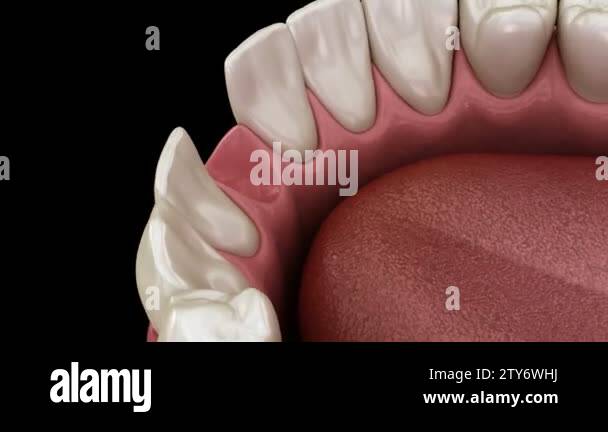 Maryland bridge made from ceramic, frontal tooth recovery. Medically ...