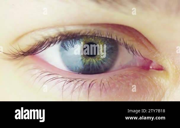 Macro View of Pupil Constriction Process in Human Eye. Constriction of ...