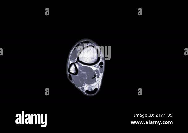mri ankle axial PDW sequence for diagnostic tendon of ankle injury Stock Video Footage - Alamy