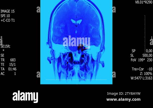 Real life man brain mri scan with tumor neoplasm medical reseach new ...
