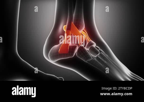 Peroneus brevis tendon Stock Videos & Footage - HD and 4K Video Clips ...