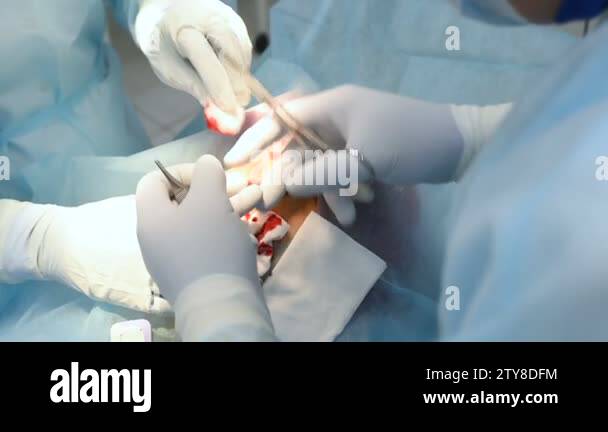 the surgeon dermatologist sutures the wound after surgical removal of a ...