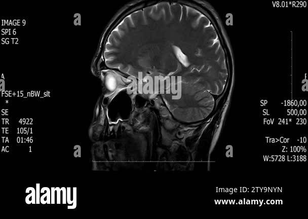 Real life man brain mri scan with tumor neoplasm medical reseach new ...