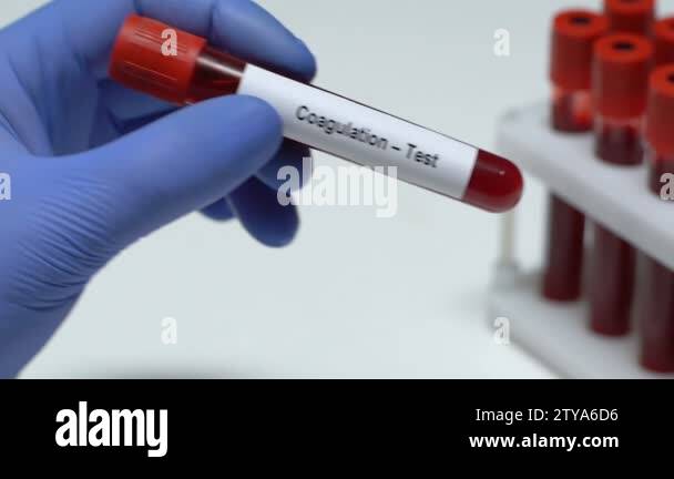 Coagulation-Test, doctor holding blood sample in tube close-up, health ...