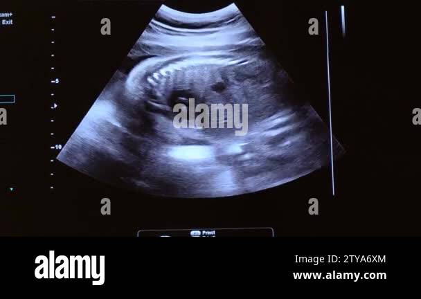 2D Ultrasound display of 28 weeks pregnant. Fetus ultrasound image that ...