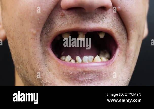 The man has rotten teeth, teeth fell out, yellow and black teeth hurt ...