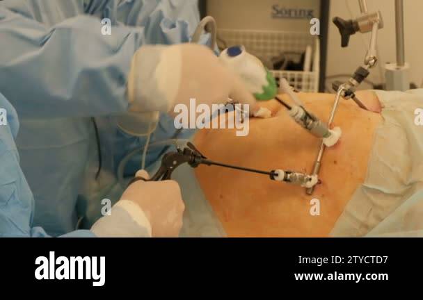Endo surgery Stock Videos & Footage - HD and 4K Video Clips - Alamy