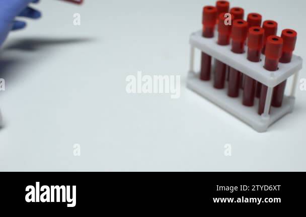Positive Western blot test, doctor showing blood sample in tube, lab ...