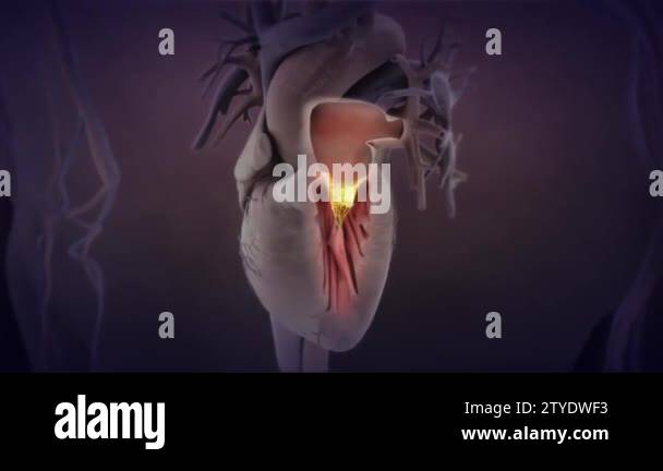 Medical Animation of Endocarditis. Spread of microbes from the ...