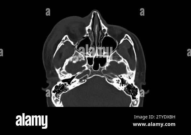 Computed tomography (CT scan ) of Orbit,A male 26 year old Traffic ...