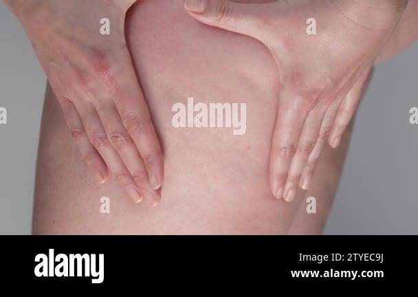 SLOW MOTION, CLOSE UP, MACRO: Fatty tissue on female's leg exposed as a ...