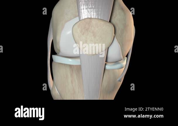 This video shows the transverse non displaced patella fracture Stock ...