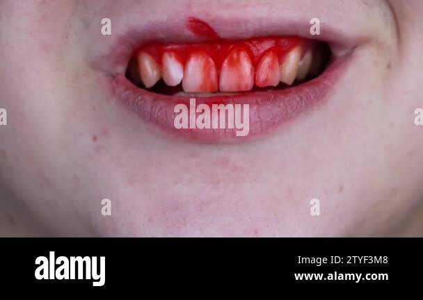 The man has blood on his teeth, severe bleeding of the gums after a ...