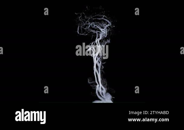 X-ray C-spine or x-ray image of Cervical spine AP view with cta carotid ...