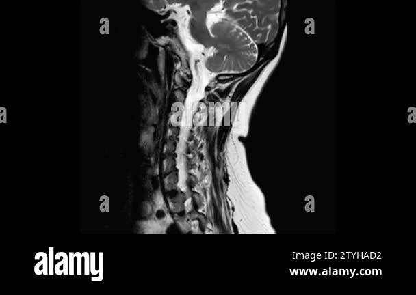 MRI of cervical spine sagittal T2W view for diagnostic Spinal Cord ...
