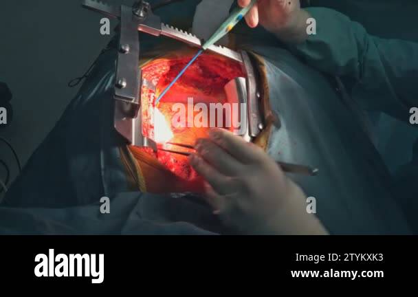 Process of open heart surgery to restart the heart after open heart ...