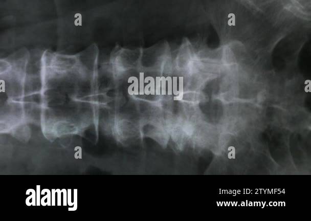 X-ray of the bones of the human vertebral column and pelvis, 4K Stock ...