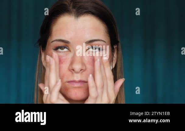 The girl with hematomas on a face. Fractional laser. Consequences of ...