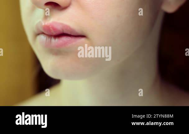 Herpes on the Upper Lip of a Young Woman. Medical Background of a Young ...