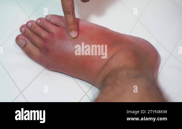 Close up old man right foot, Ankle wounded waiting and swelling ...