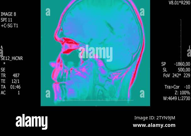 Real life man brain mri scan with tumor neoplasm medical reseach new ...