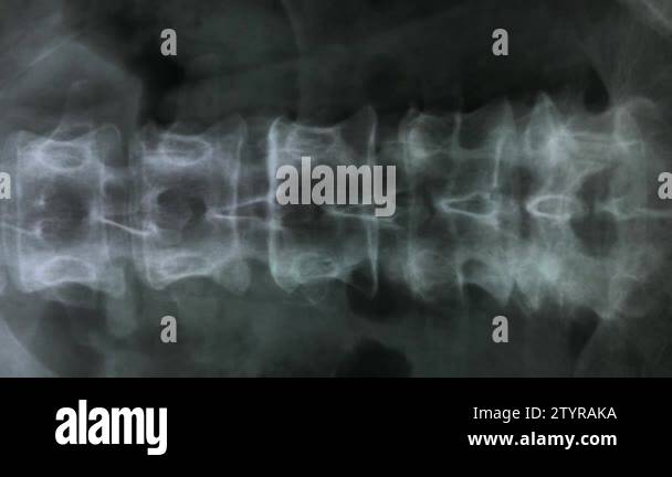X-ray of the bones of the human vertebral column and pelvis, 4K Stock ...