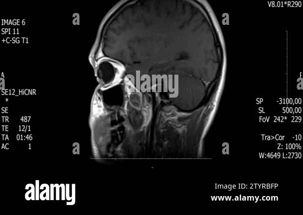 Real life man brain mri scan with tumor neoplasm medical reseach new ...