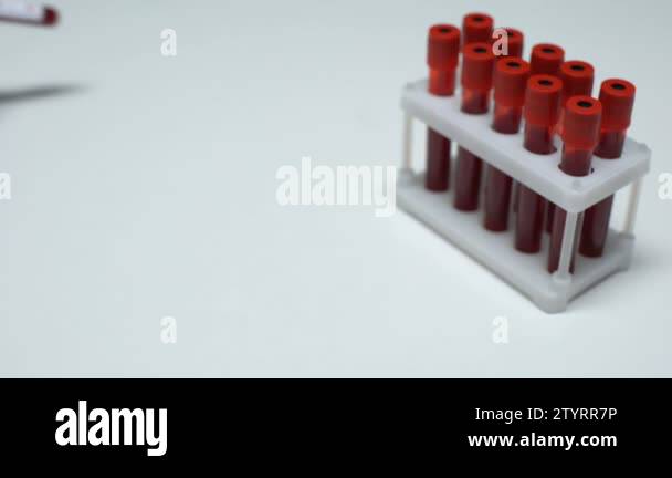 Positive Uric acid test, doctor shows blood sample, lab research ...