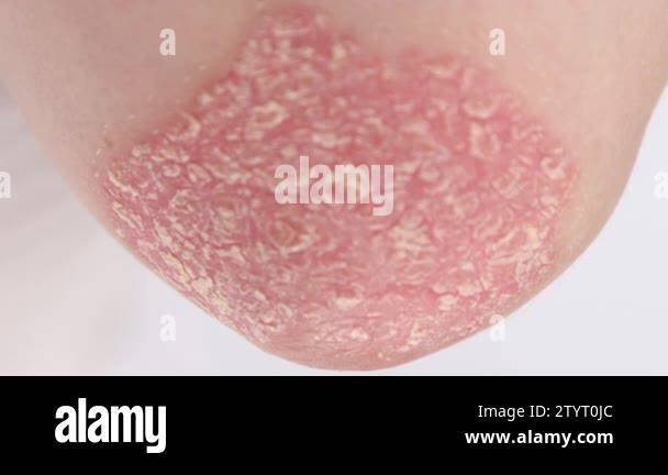 CLOSE UP, MACRO: Detail of dry silver scales covering red inflamed skin ...