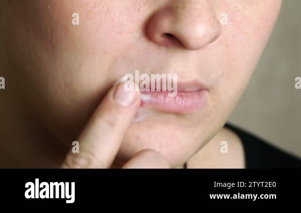 Woman rubs ointment on the wound on his lip.Chill on the lips,cold ...