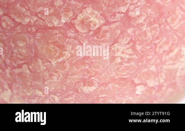 Close Up Macro Detail Of Dry Silver Scales Covering Red Inflamed Skin On An Elbow Affected By