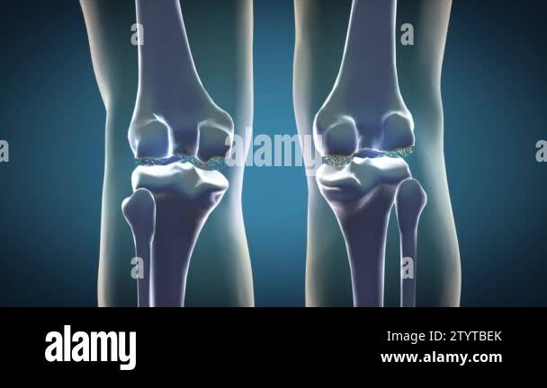 3D rendered shot of knee bone damaged from osteoarthritis was ...