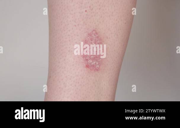 CLOSE UP: Flaky skin on unrecognizable psoriasis patient slowly peeling ...