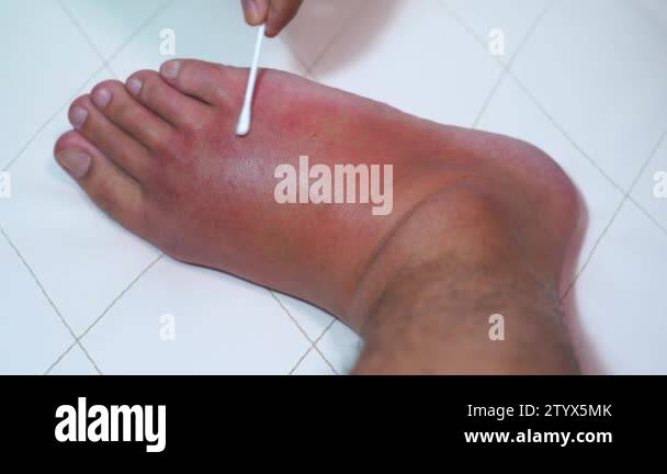 Close up old man right foot, Ankle wounded waiting and swelling ...