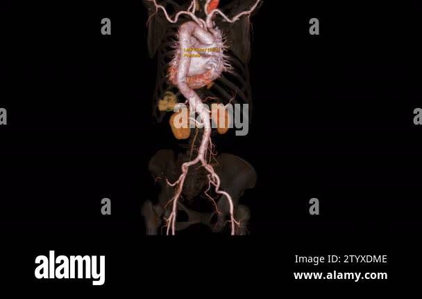 CTA Whole aorta 3D rendering image with transparent bone turn around on the screen for detect ...