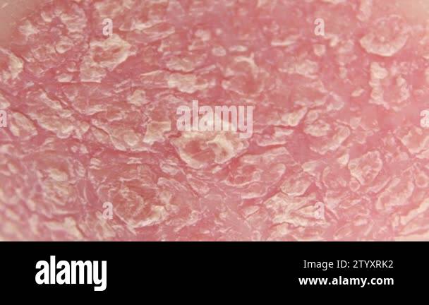CLOSE UP, MACRO: Detail of dry silver scales covering red inflamed skin ...