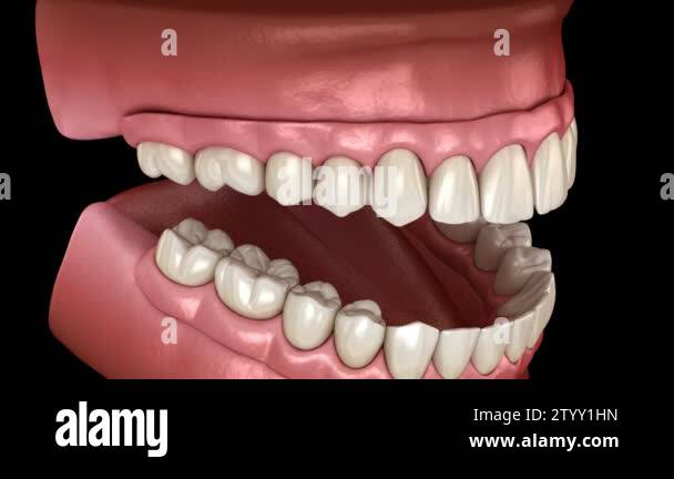 Maxillary prosthesis All on 4 system supported by implants. Medically ...