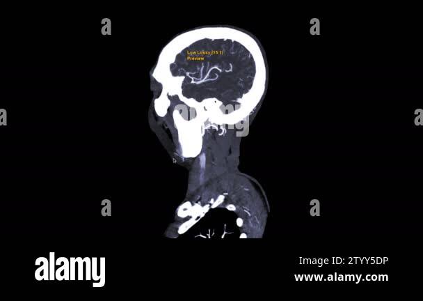 CTA Brain or computed tomography angiography of the brain sagittal mip ...