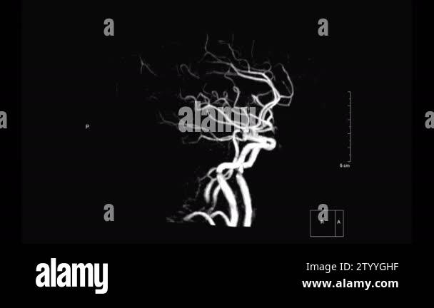 MRA Brain or Magnetic resonance angiography of Cerebral artery in the ...